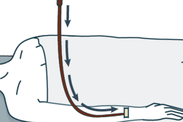 Hemafuse | Sisu Global Health